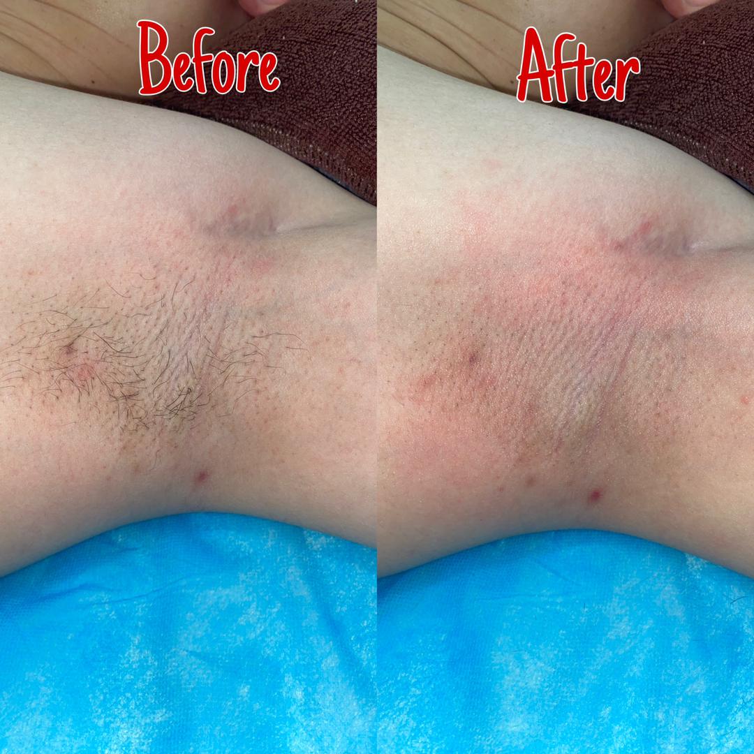 Underarms Progress | AM Skin Factories