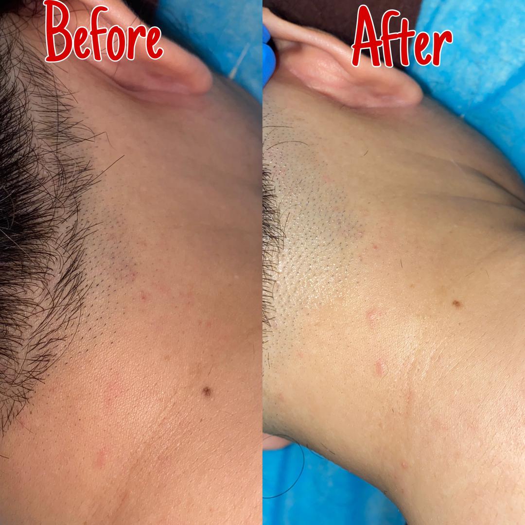 Nape Super Hair Removal | AM Skin Factories