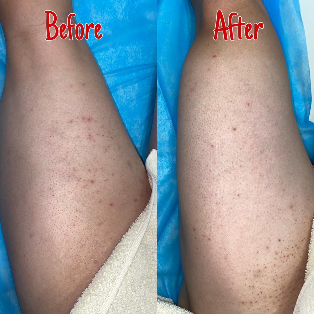 SHR : Upper Knees Progress | AM Skin Factories