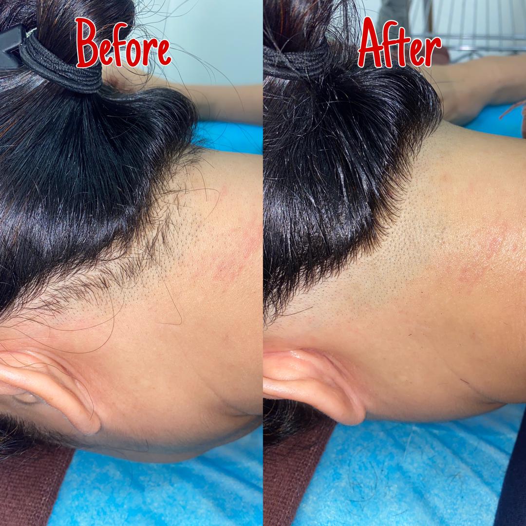 Nape Hair Removal Progress | AM Skin Factories